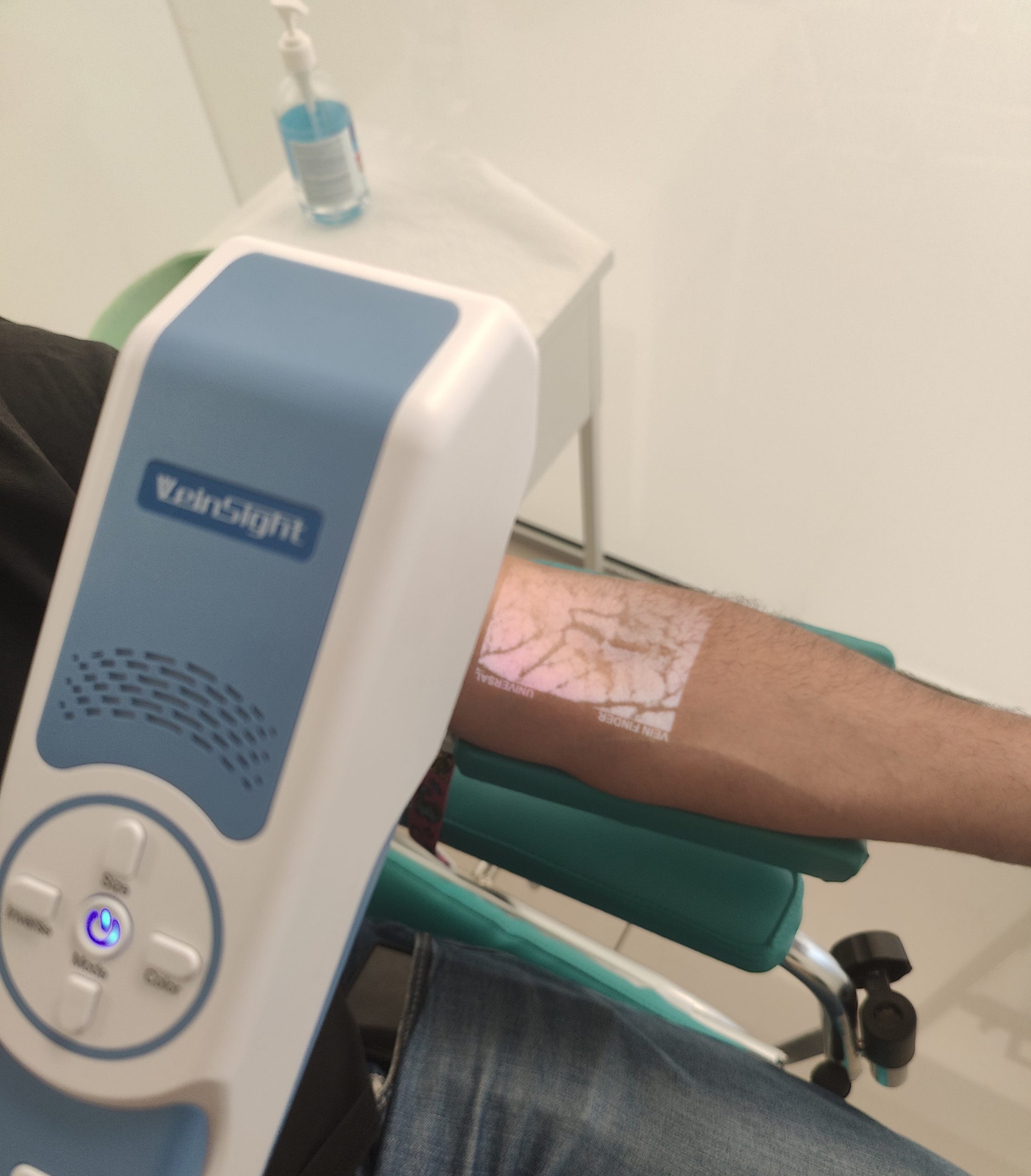 BAT TEST-BASOPHIL ACTIVATION TEST